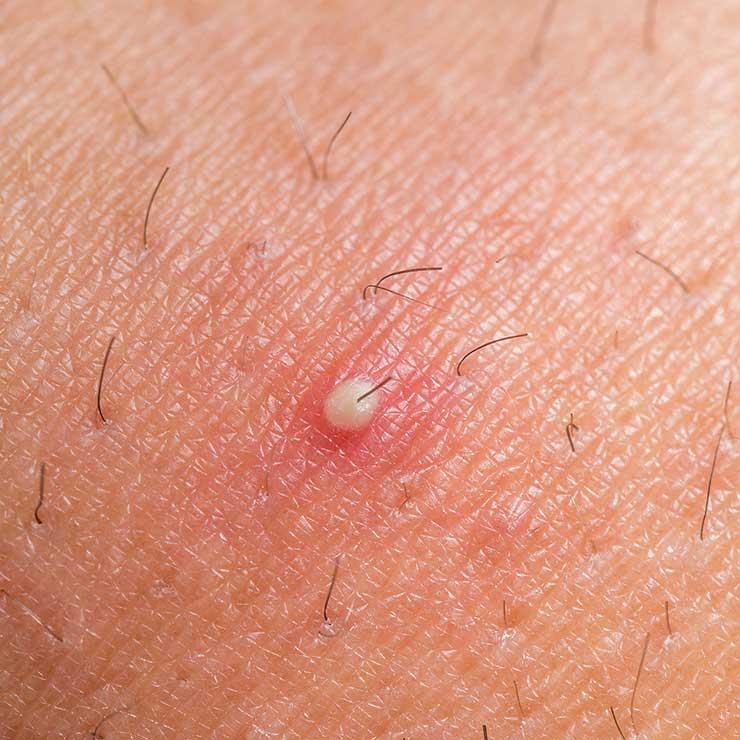 Different Types Of Bumps On Skin
