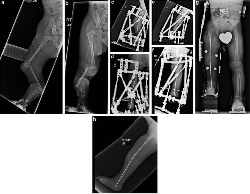 What Is Tibial Hemimelia? | Faculty of Medicine