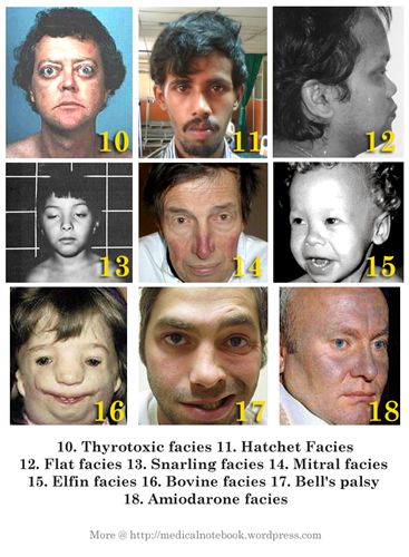 Facies in different medical conditions | Faculty of Medicine