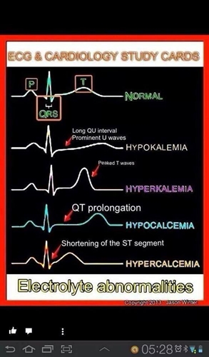 ECG Changes With Electrolytes Imbalance | Faculty of Medicine