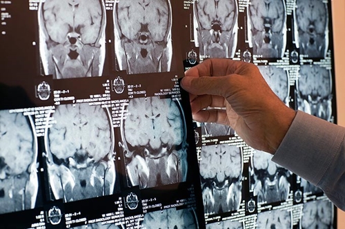 The Incredible Shrinking Human Brain | Faculty of Medicine