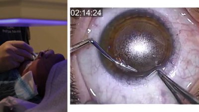 LASIK Eye Surgery Explained By Video | Faculty of Medicine