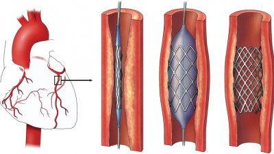 Angioplasty Procedure Animation Video. | Faculty of Medicine