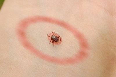 A New Lyme Disease Vaccine Will Soon Be Tested On Americans And ...
