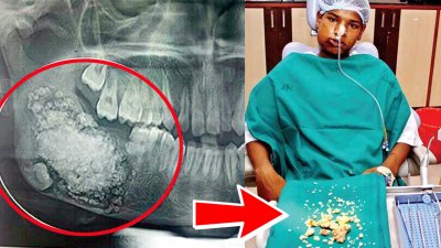 Teen Says His Cheek Hurts, Then Doctors Find 232 Teeth Inside His Mouth ...