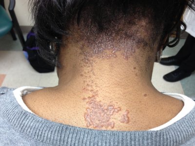 Subcutaneous skin lesions | Faculty of Medicine