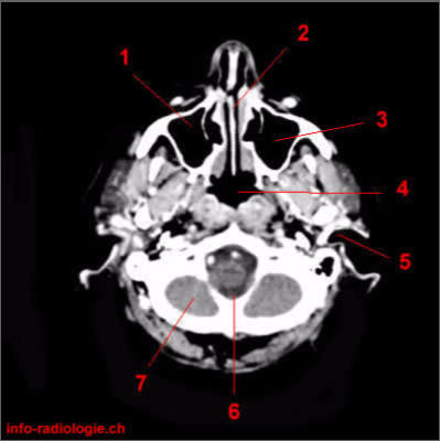 How To Read CT Scan: CT Head | Faculty of Medicine